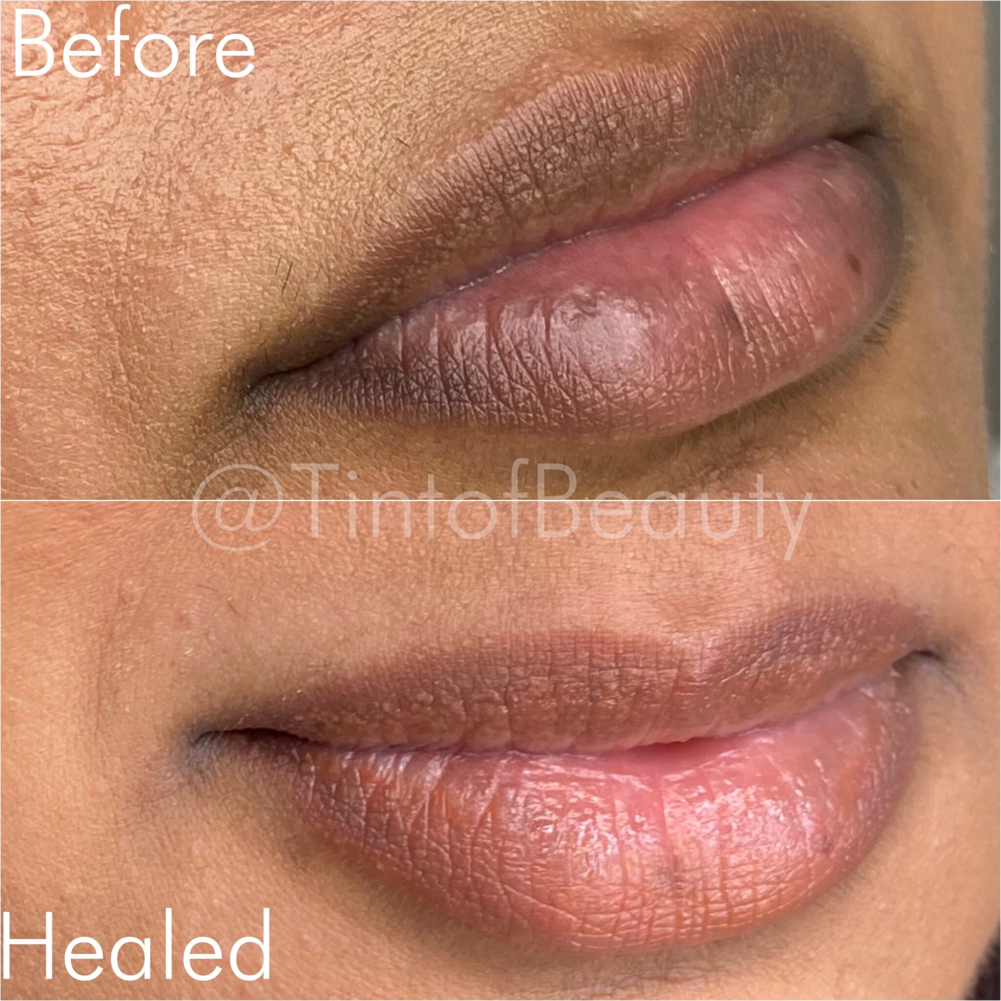 What is Lip Neutralization? Here's Everything You Should Know!